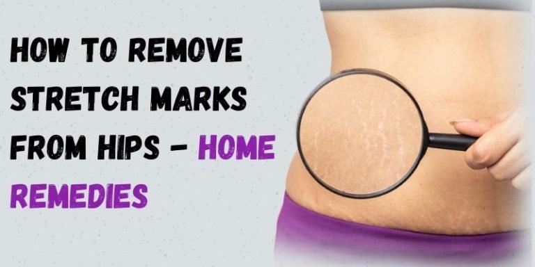 How to Remove Stretch Marks from hips, stomach, thighs | Crazy Hints